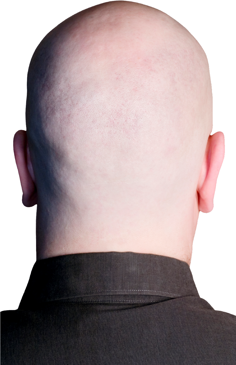 Download See Original Image Bald Person, Bald Heads, Hair Transplant ...