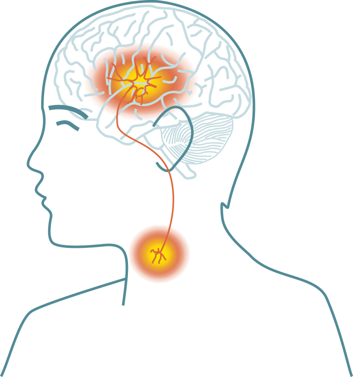 A Disease Of The People - Stroke Disease Transparent Background Clipart ...