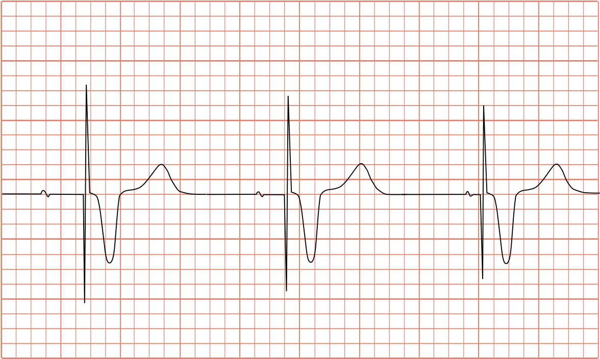 Ecg Pacemaker Syndrome - Ecg Pacemaker Clipart - Large Size Png Image ...