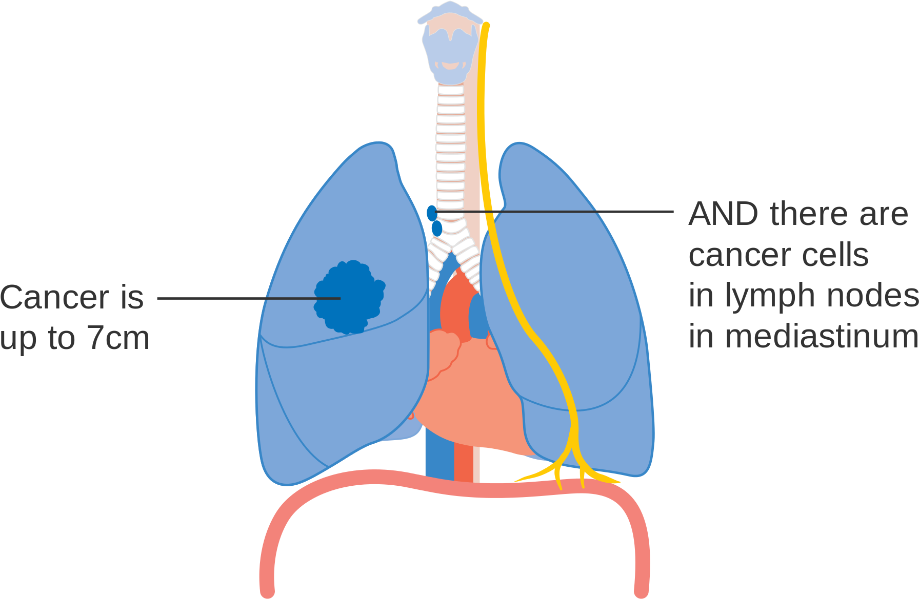 Lung Cancer Stage Diagram