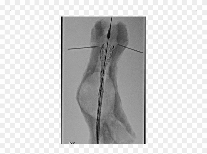 Fluoroscopy Of Stent Graft Inside A Silicone Shell - Figure Drawing ...