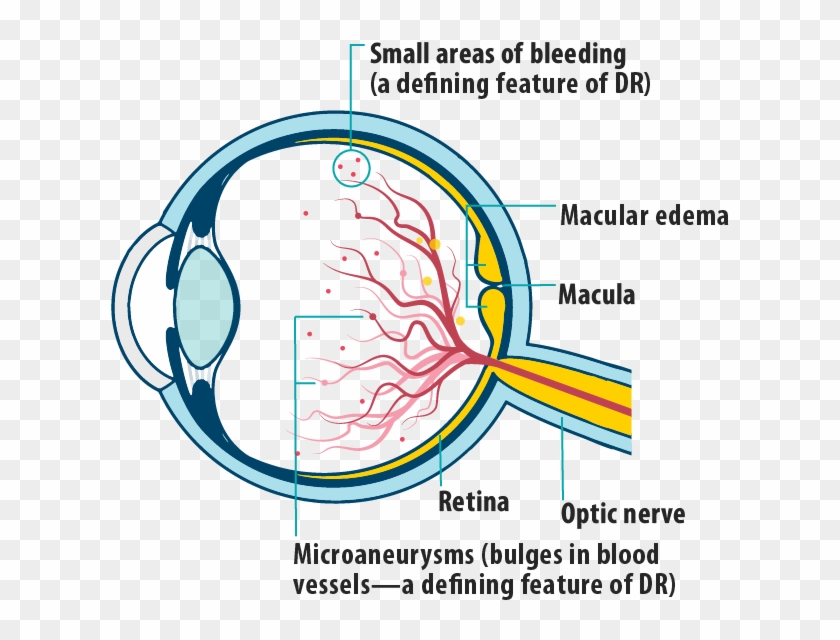 Picture Of Effects Of Dme/dr In Dme On The Eye, Showing - Central ...