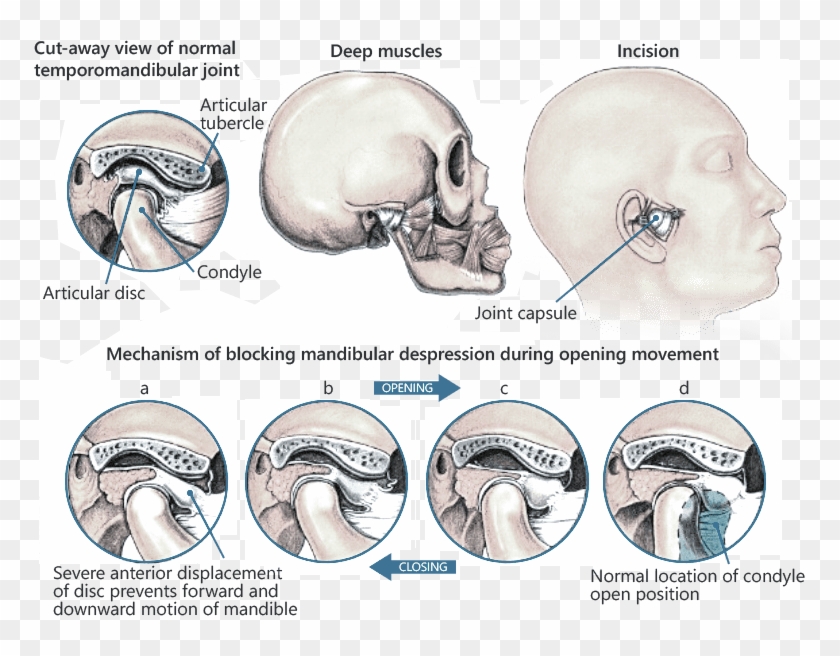 Symptoms Of Tmj Disorders - Tmj Disorder Clipart (#3281253) - PikPng