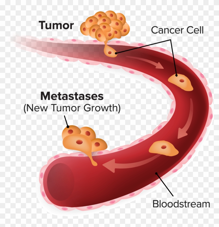 Download Metastasis - Cancer Cell Metastasis Clipart Png Download - PikPng Download Metastasis - Cancer Cell Metastasis Clipart Png Download - PikPng