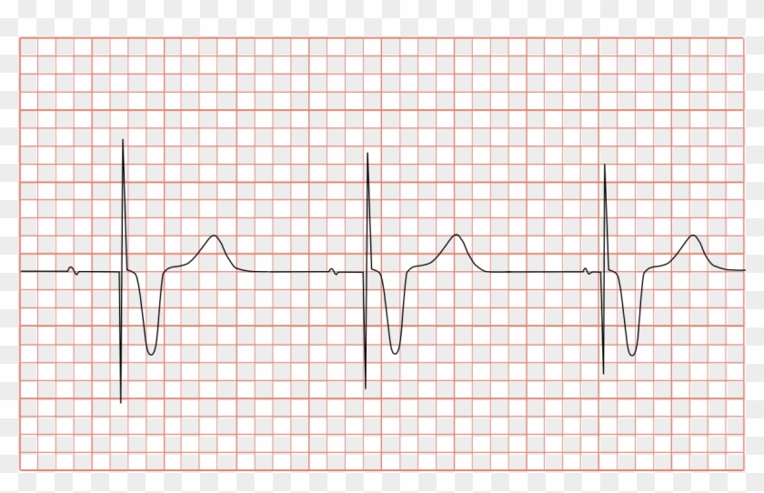 Ecg Pacemaker Syndrome - Ecg Pacemaker Clipart (#5166108) - PikPng