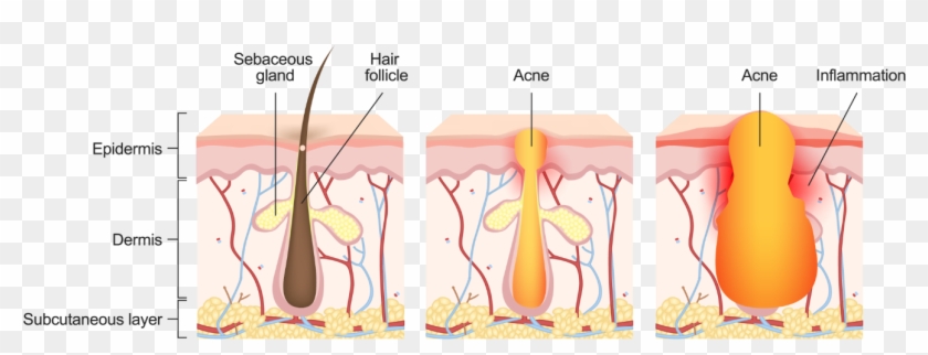Acne Occurs When A Hair Follicle And Its Associated - Illustration ...